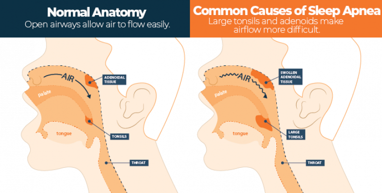 Sleep Apnea in Children – Signs, Symptoms, and Treatments Sleep Apnea in Children – Signs, Symptoms, and Treatments